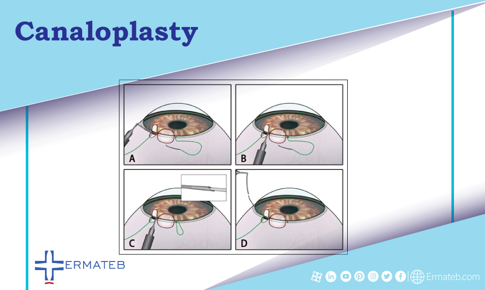 What are the mostly done eye surgeries in iran