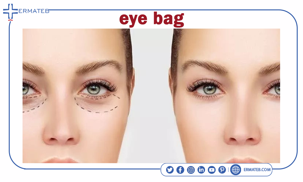 Ways To Get Rid Of EyeBags| Surgical, Non-Surgical, Home Remedies